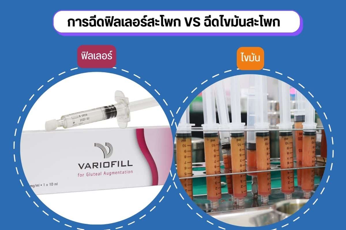 ฟิลเลอร์สะโพก 10 อันดับคลินิกฉีดสะโพกที่ดีที่สุด อัพเดต 2024