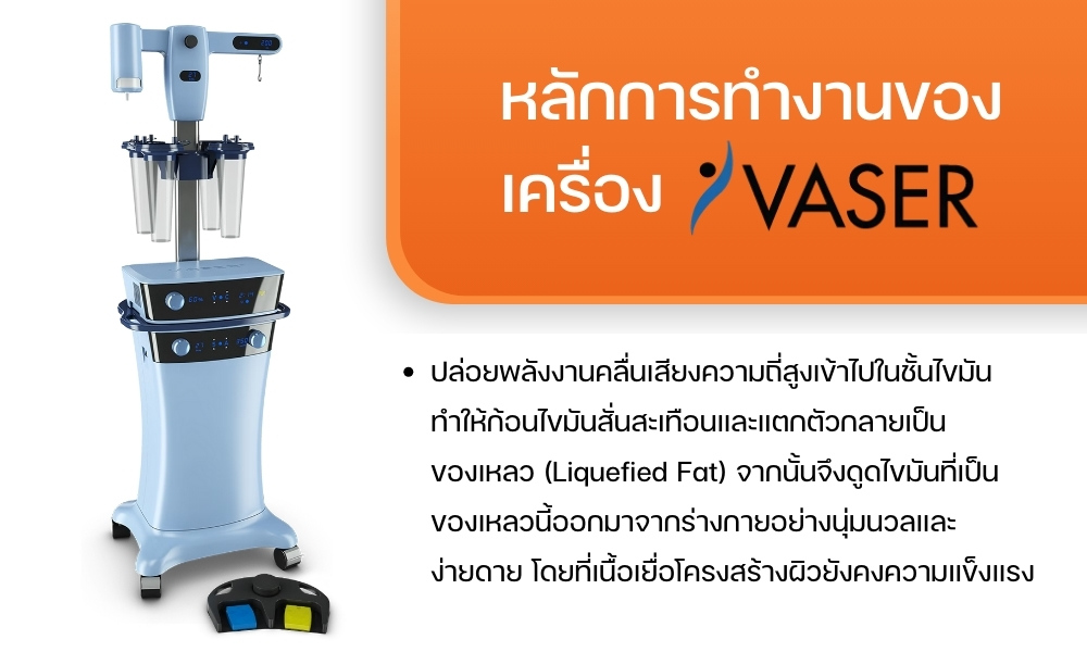 ดูดไขมันด้วยเครื่อง VASER ลดไขมันส่วนเกินได้สัดส่วนในครั้งเดียว